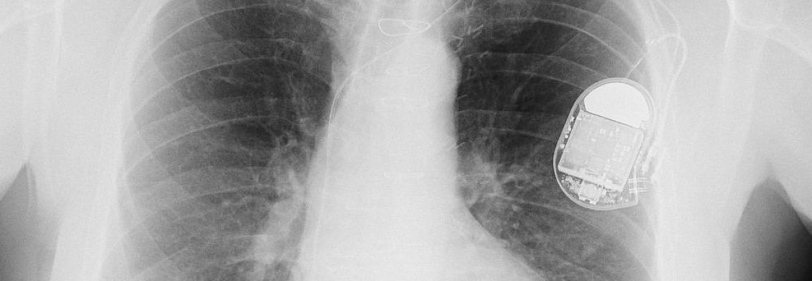 Pacemaker Clinics - Heart Health | Island Health